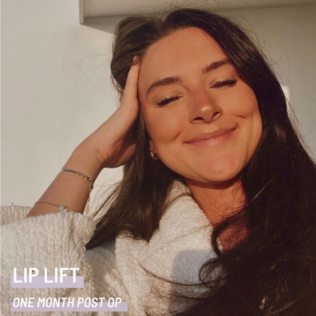 Lip Lift NYC | Lip Specialist New York