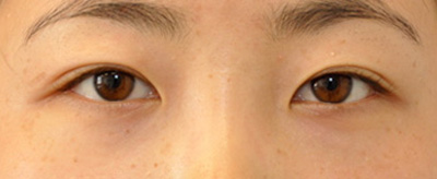 Eyelid Surgery Before and After | Dr. Edward Kwak
