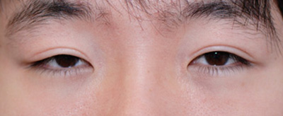 Multiple Crease Asian Eyelid Before & After 01