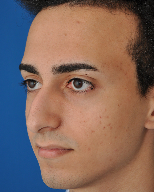 Rhinoplasty Before & After 26