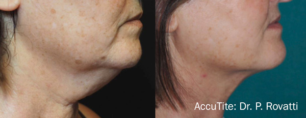 AccuTite NYC | Dr. Edward Kwak