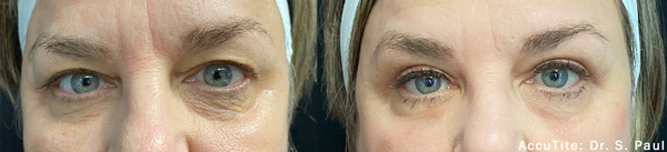 AccuTite NYC | Dr. Edward Kwak