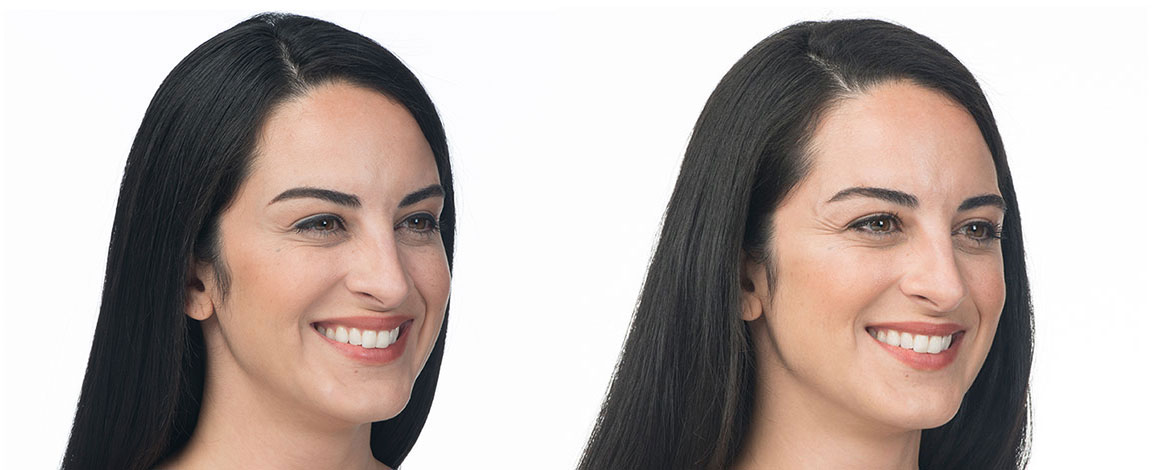 Botox NYC | Dysport & Botox New York City