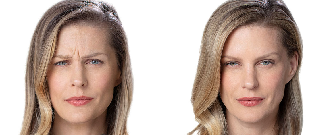 Botox NYC | Dysport & Botox New York City