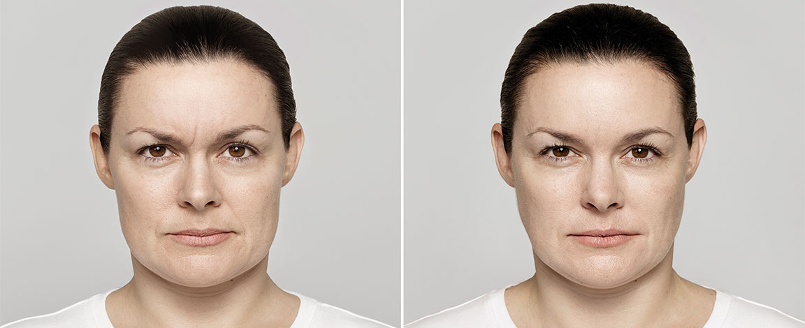 Botox NYC | Dysport & Botox New York City