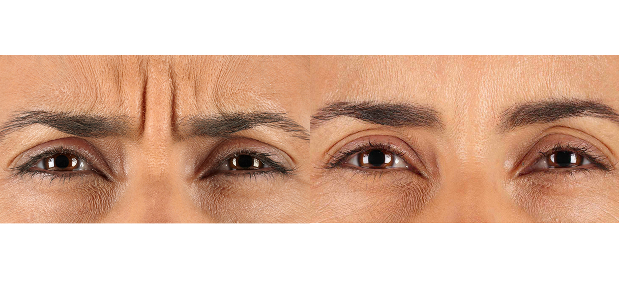 Botox NYC | Dysport & Botox New York City