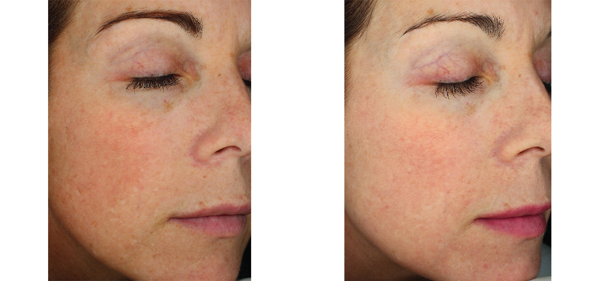 Halo Laser Resurfacing NYC | Halo Laser Treatment New York