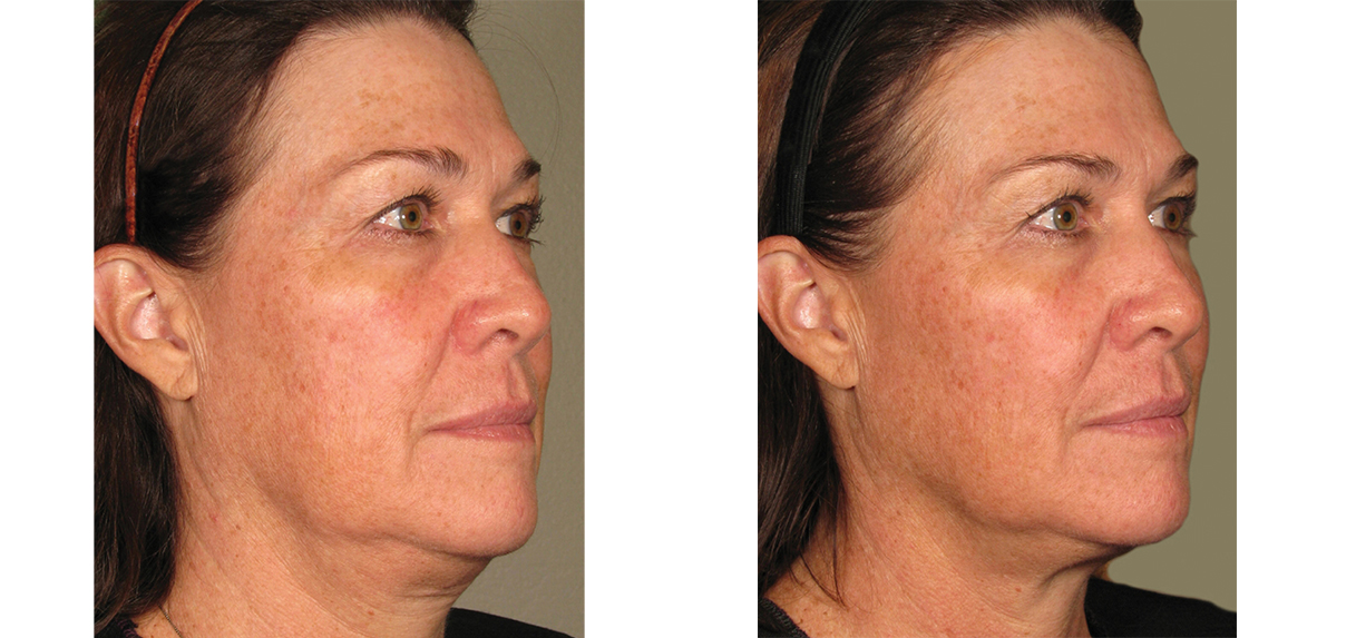 Ultherapy NYC | Facial Plastic Surgeon NYC